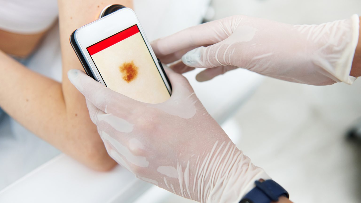 AI skin cancer screening as accurate as medical professionals