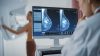 AI breast cancer screening to revolutionise early detection in UK